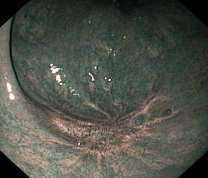 SPED - Cromoendoscopia